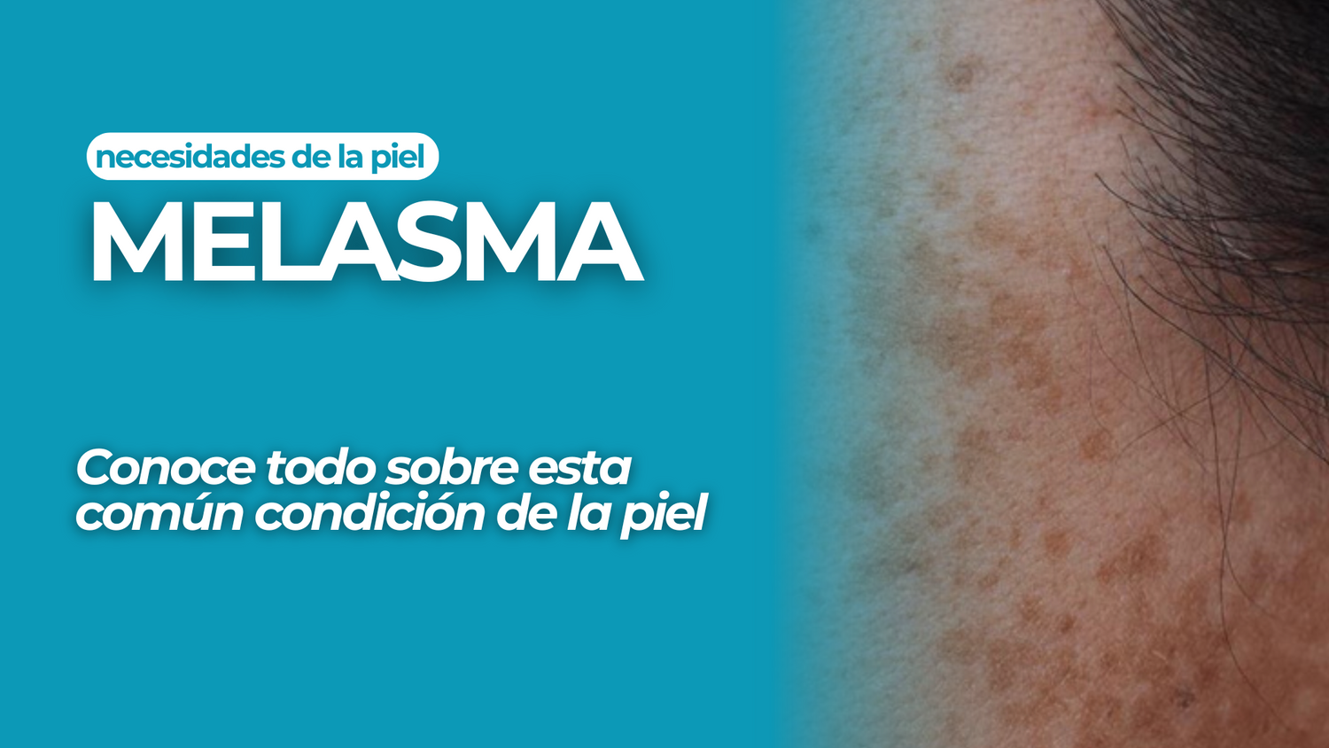 Conoce todo sobre el Melasma – Bramasole Spa & Esthetic